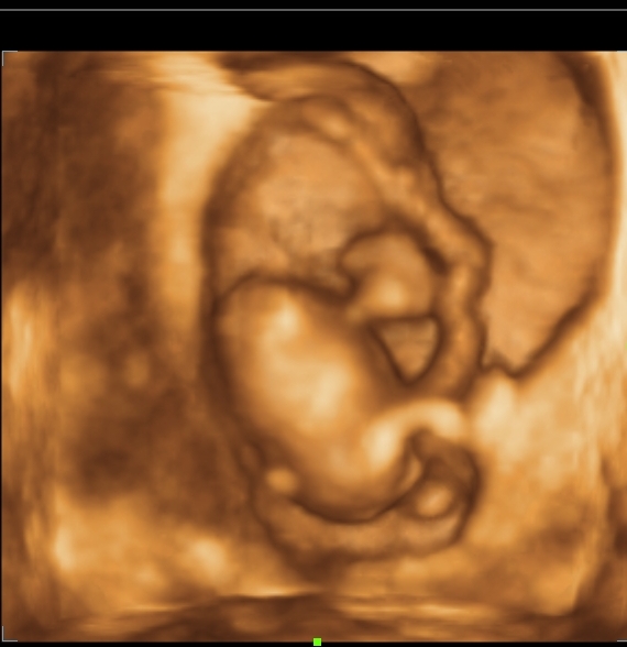 BANGALORE ULTRASOUND BLOG: 3D/4D scan for pregnancy