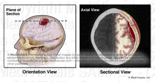 The Medical Legal Exhibit Expert Blog: Medical Legal Illustration and ...