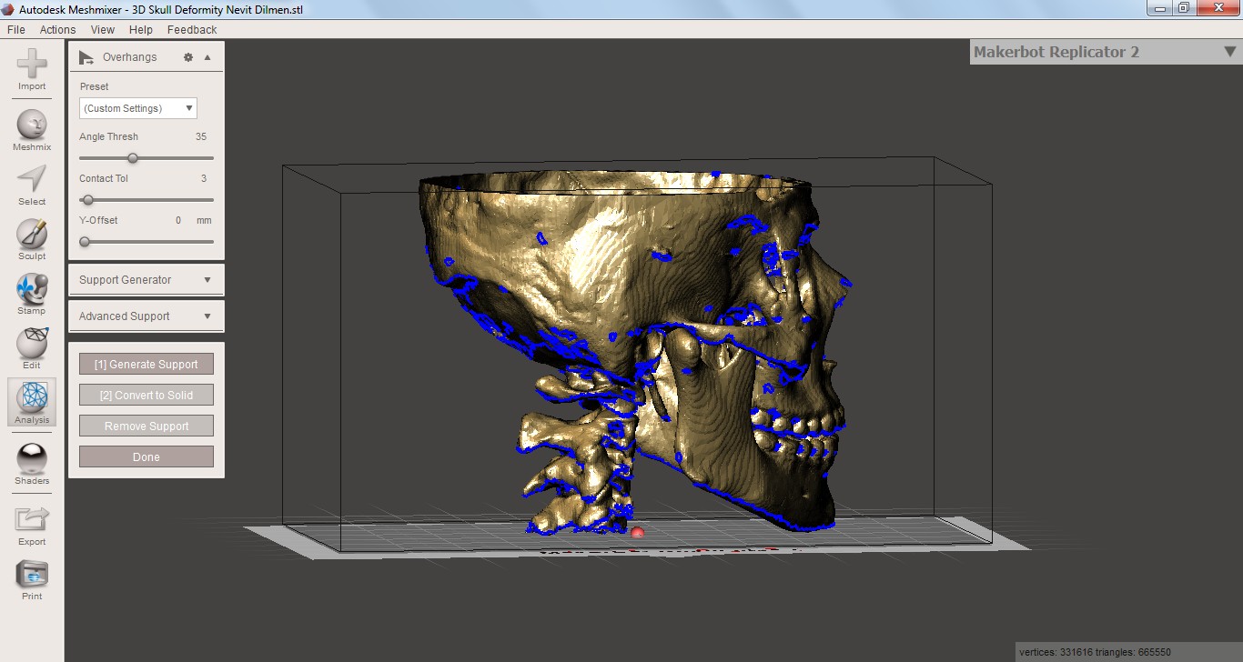 Nevit's blog: Using MeshMixer to cut and prepare a large medical model ...