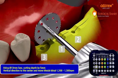 IMPLANTOLOGY: Hiossen / Osstem - ESSET Kit Animation