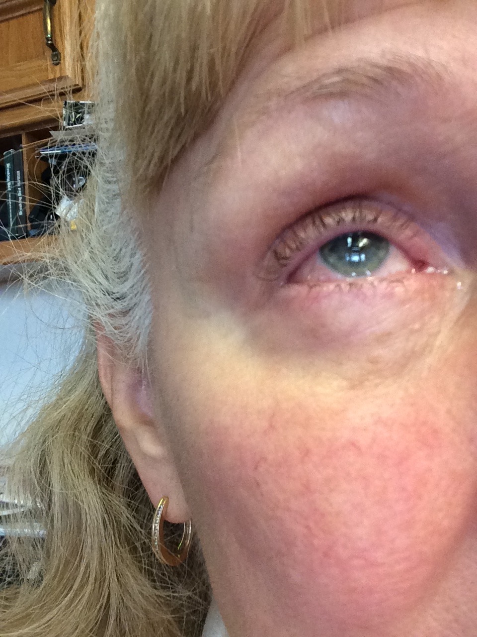 Living With Nickel & Iron Oxide Allergies: Nickel Exposure Side Effects ...