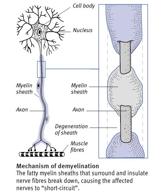 Mechanism of demyelination ~ Nursing