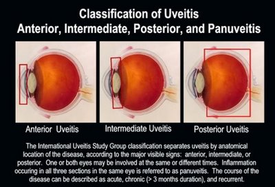Miranza IOA: LA UVEITIS