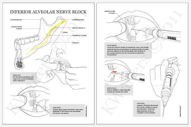 Inferior Alveolar Nerve Block: Anatomical consideration and Technique ...