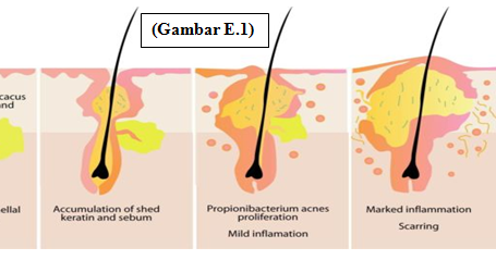 Obat Jerawat (Swamedikasi)
