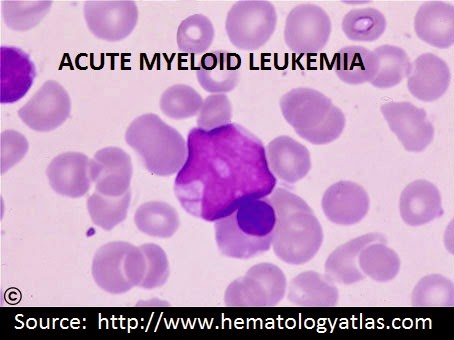 Lab Atlas: Acute Myeloid Leukemia