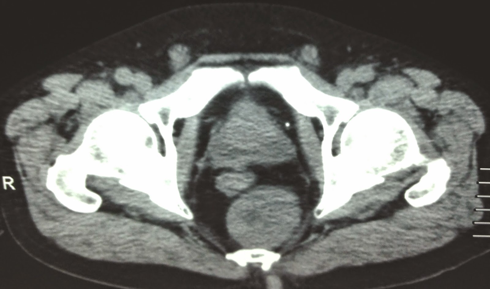 VIETNAMESE MEDIC ULTRASOUND: CASE 305: Presacral Tumor, Dr PHAN THANH ...