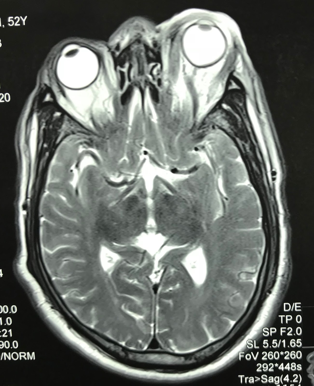 VIETNAMESE MEDIC ULTRASOUND: CASE 477: LEFT EXOPTHALMIC EYE, Dr PHAN ...