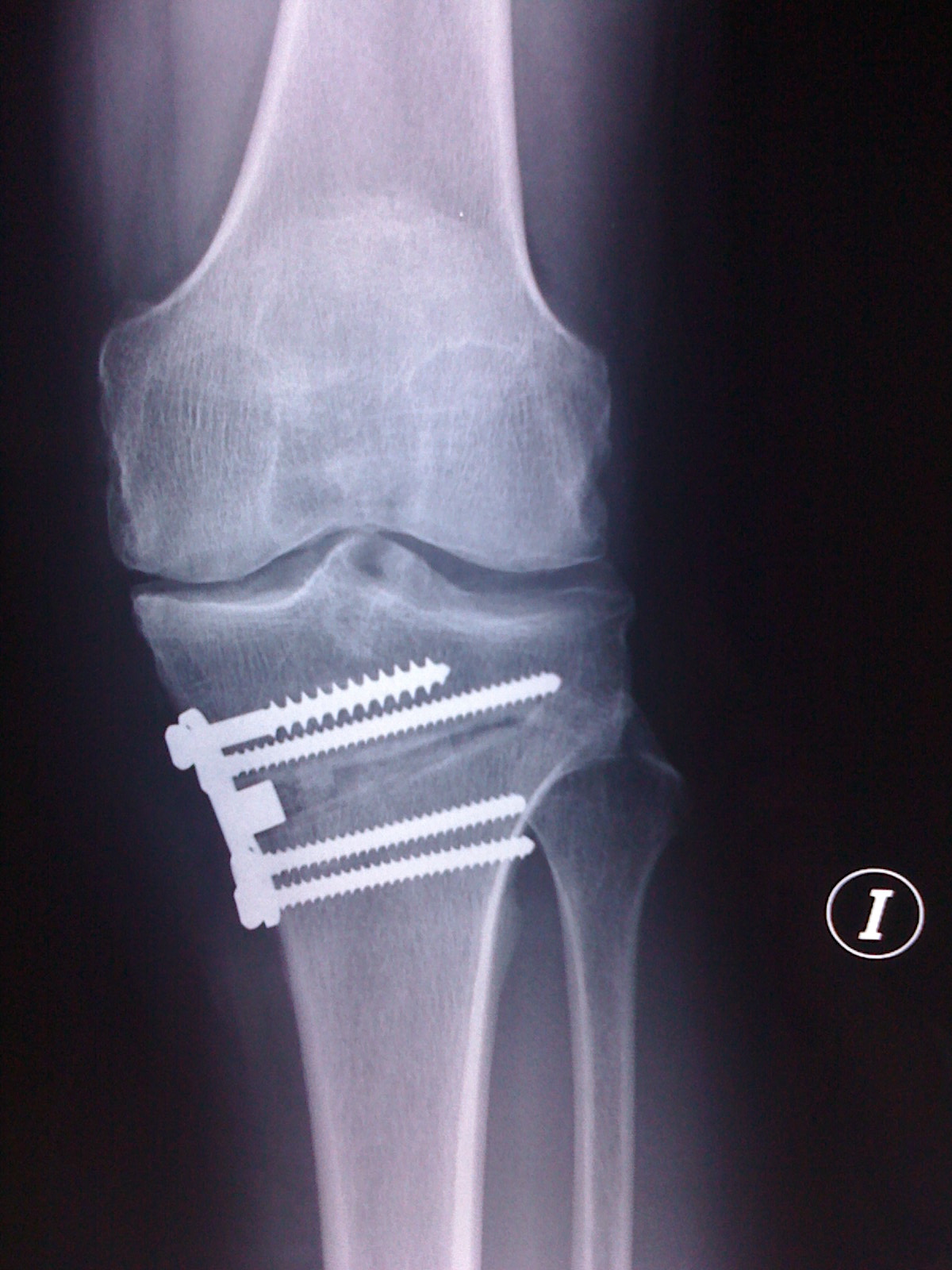RODILLA Y HOMBRO: OSTEOTOMIA DE ALINEACIÓN DE LA RODILLA