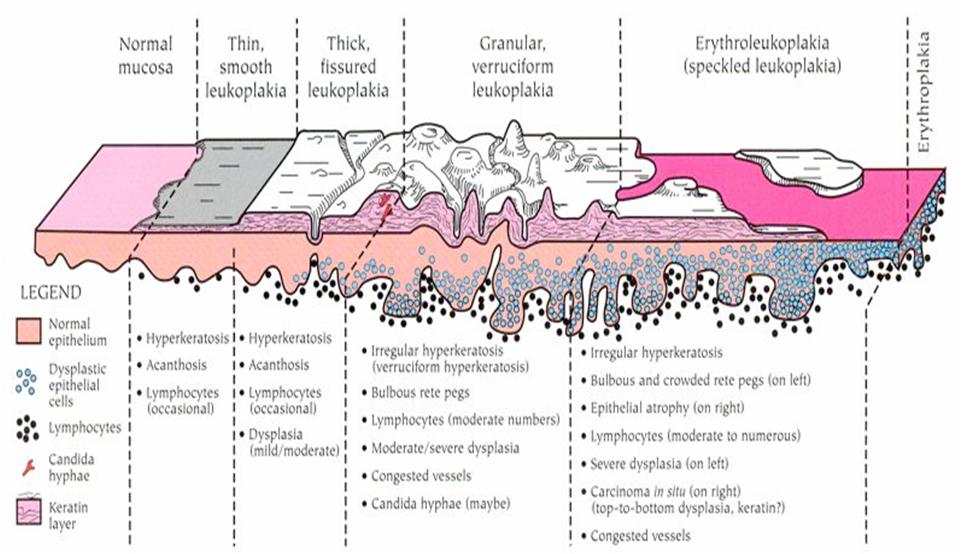 Dentistry lectures for MFDS/MJDF/NBDE/ORE: Facts on Leukoplakia ...