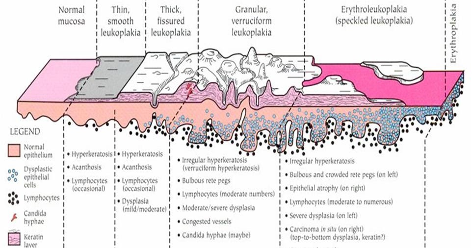 Dentistry lectures for MFDS/MJDF/NBDE/ORE: Facts on Leukoplakia ...