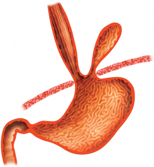 Hiatus Hernia: Hiatus Hernia - Signs and symptoms, Will cause along ...