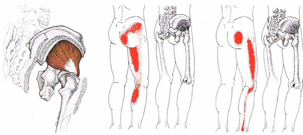 Ideal Balance Acupuncture: Trigger Points and Pain