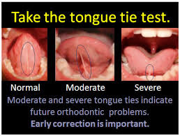 Pediatric Dentist, Bangalore: TONGUE TIE And How It Affects Children's ...