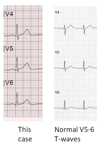 Dr. Smith's ECG Blog: 2011