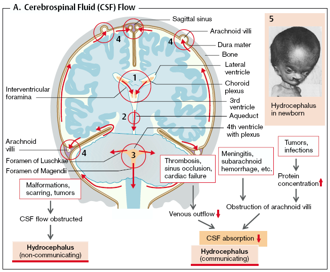 Mengenal Hidrosefalus | Coretan Medis - Medical Things
