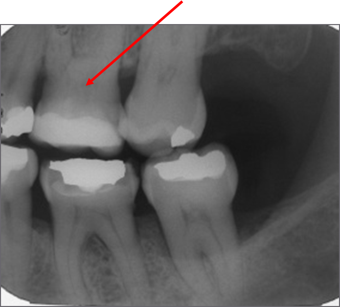 Radiología oral y maxilofacial: Interpretación de patologías pulpares y ...