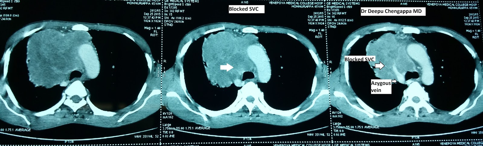 Chest Medicine Made Easy-Dr Deepu: Superior Venecaval Syndrome