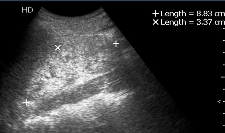 Renal Parenchymal Disease Symptoms : What Does Gross Cystitis Mean in ...