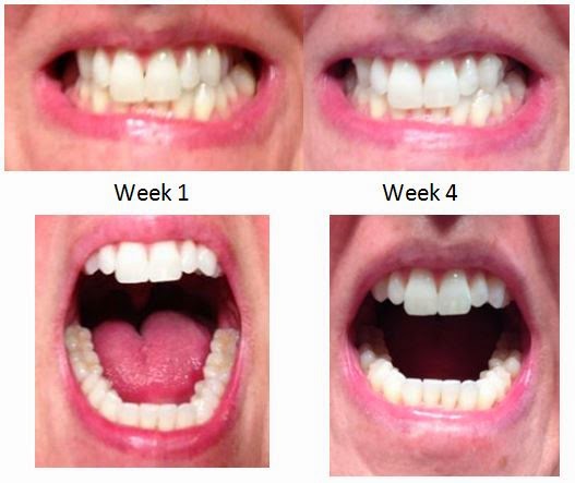 My Invisalign Chronicles: Week 5 - Tray Set 3 & Progress Update