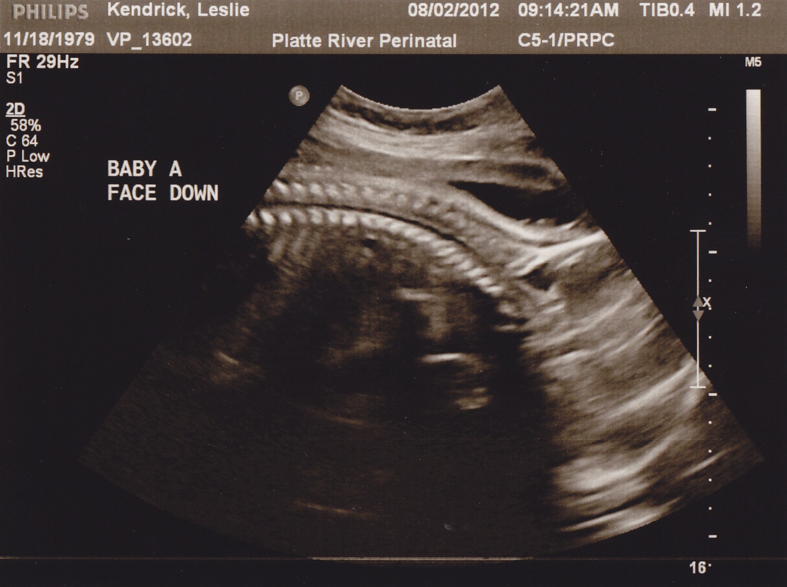 Two Babies, 280 Days, One Womb: 31 Week Ultrasound