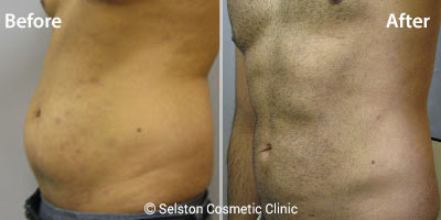 Selston Cosmetic Clinic: Vaser Lipo on Men's Abs Before and After ...