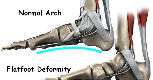 Dr. K. Lam Straight Talk: Posterior Tibial Tendon / Flatten Arches ...