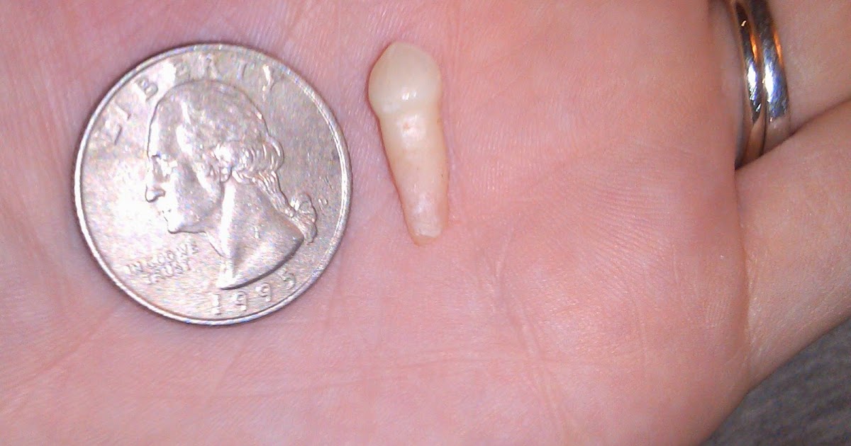 From Tracie: Do Baby Teeth Have Roots?