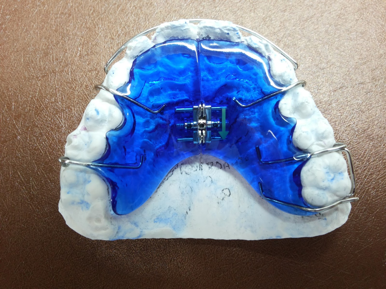 Ortobella: Aparelhos de expansão com arco de hawley.(batente anterior ...