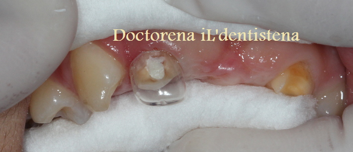 My Dental Diary: Strip Crowns