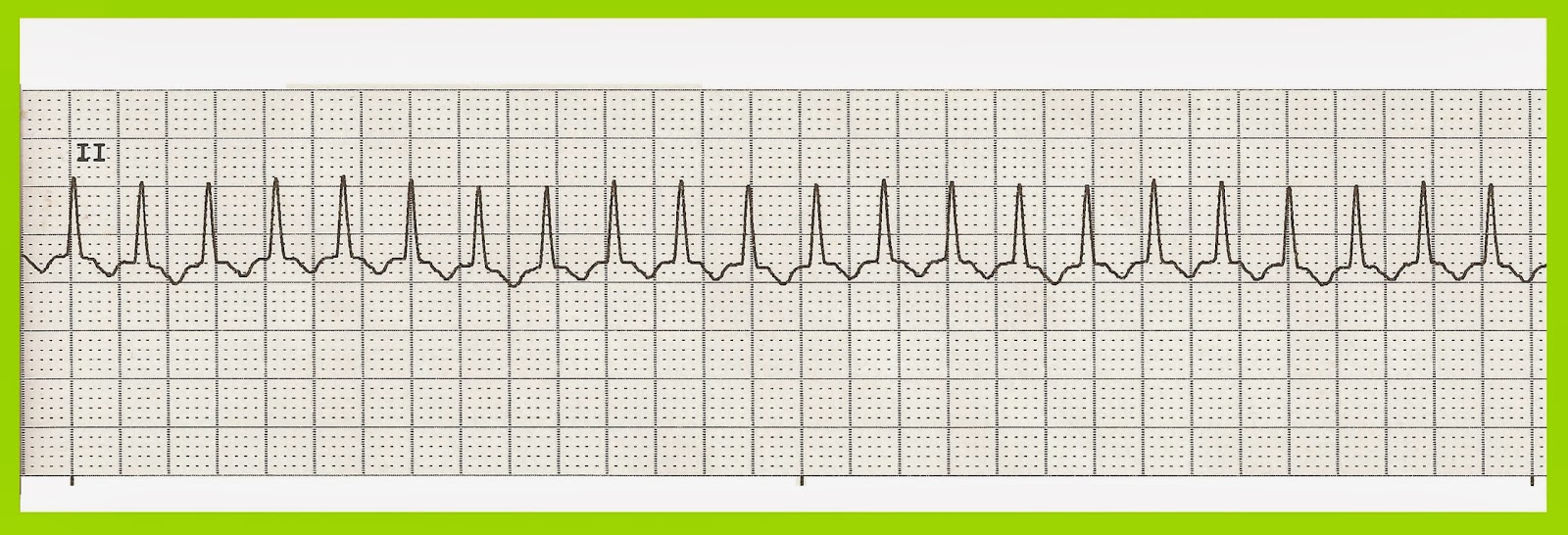 Practice EKG Rhythm Strips 215