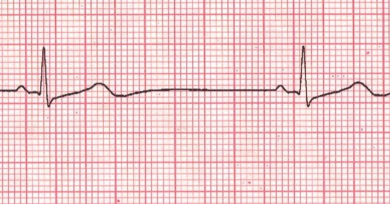 Study Medical Photos: Introduction To Bradycardia