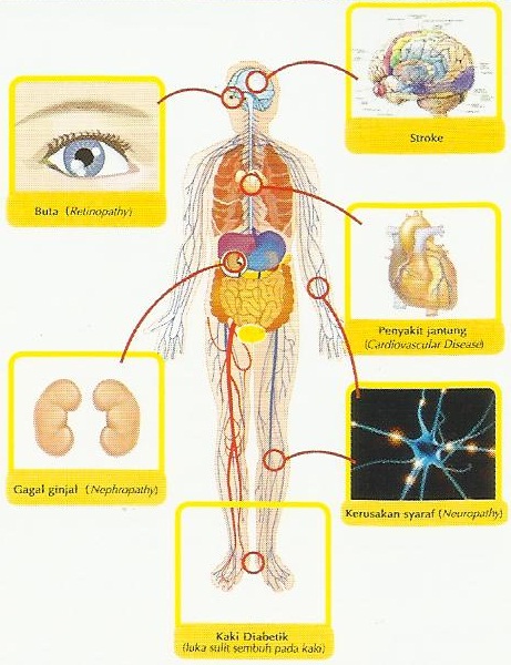 Seputar Diabetes Melitus - Ngintips-Kesehatan