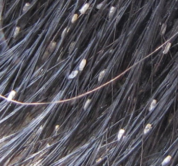 How To Get Rid Of Lice Fast - Caraway Seeds Health Benefits