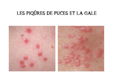 Les piqûres de puces et la gale - Comment sont-ils différents? | Piqûre ...