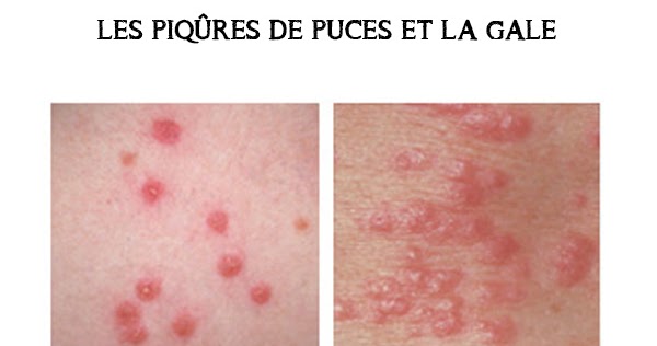 Comment son les bouton de la gale - Dawn Dorsey