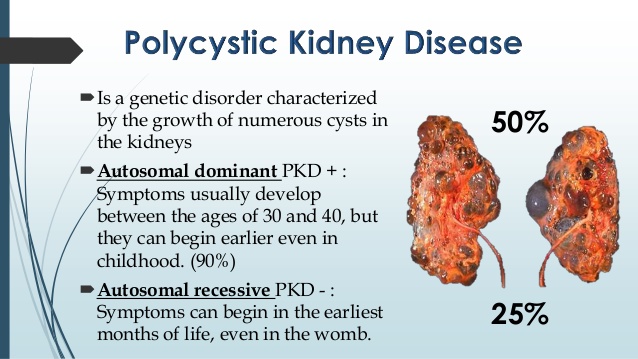 Natural Health And Beauty Tips: Get Best Polycystic Kidney Disease ...
