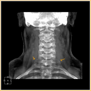 Cervical Ribs-CT - Sumer's Radiology Blog