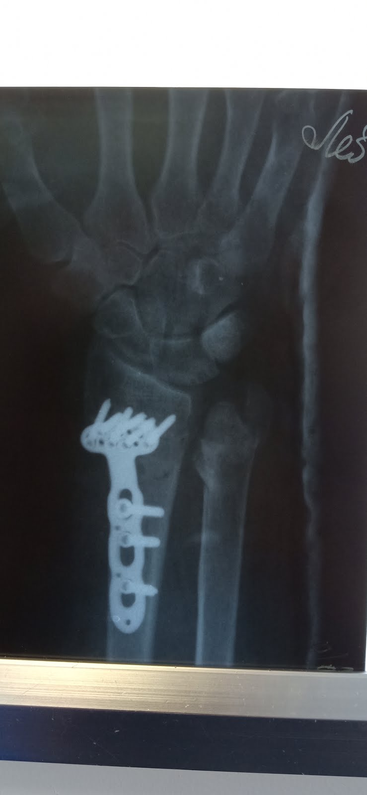 CASE PRESENTATION OF TYPE COLLES’ FRACTURE