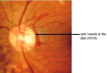 Dr.EDUARDO BERCOVICH: Dibetes tipo 1: Complicaciones Crónicas, Retinopatía