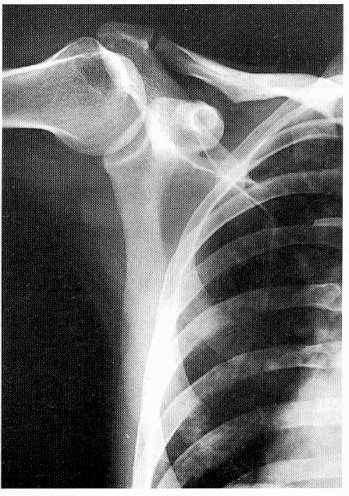 Tecnicas Radiológicas 2011: Escàpula, Proyeccion AP