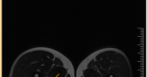 Biceps Femoris Tear-MRI - Sumer's Radiology Blog