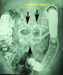 Tozande: MEZZI DIAGNOSTICI DEL COLON-RETTO