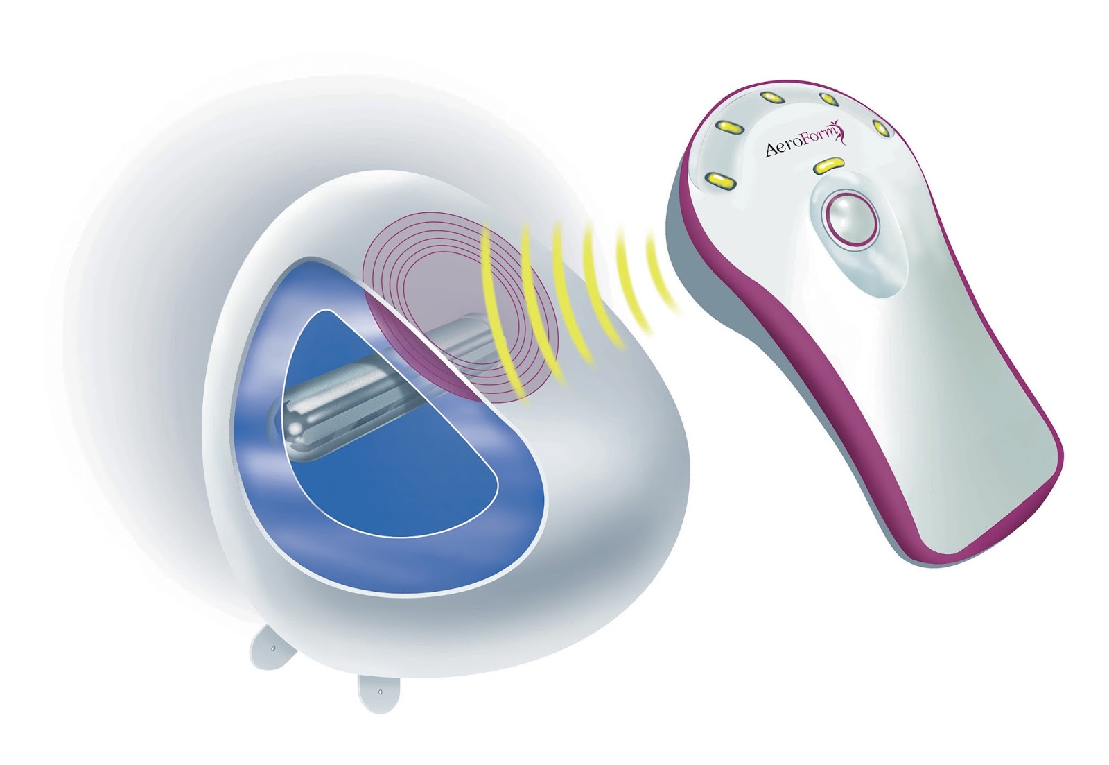 Ob/Gyn Updated : FDA Approves Novel AeroForm Tissue Expander system for ...