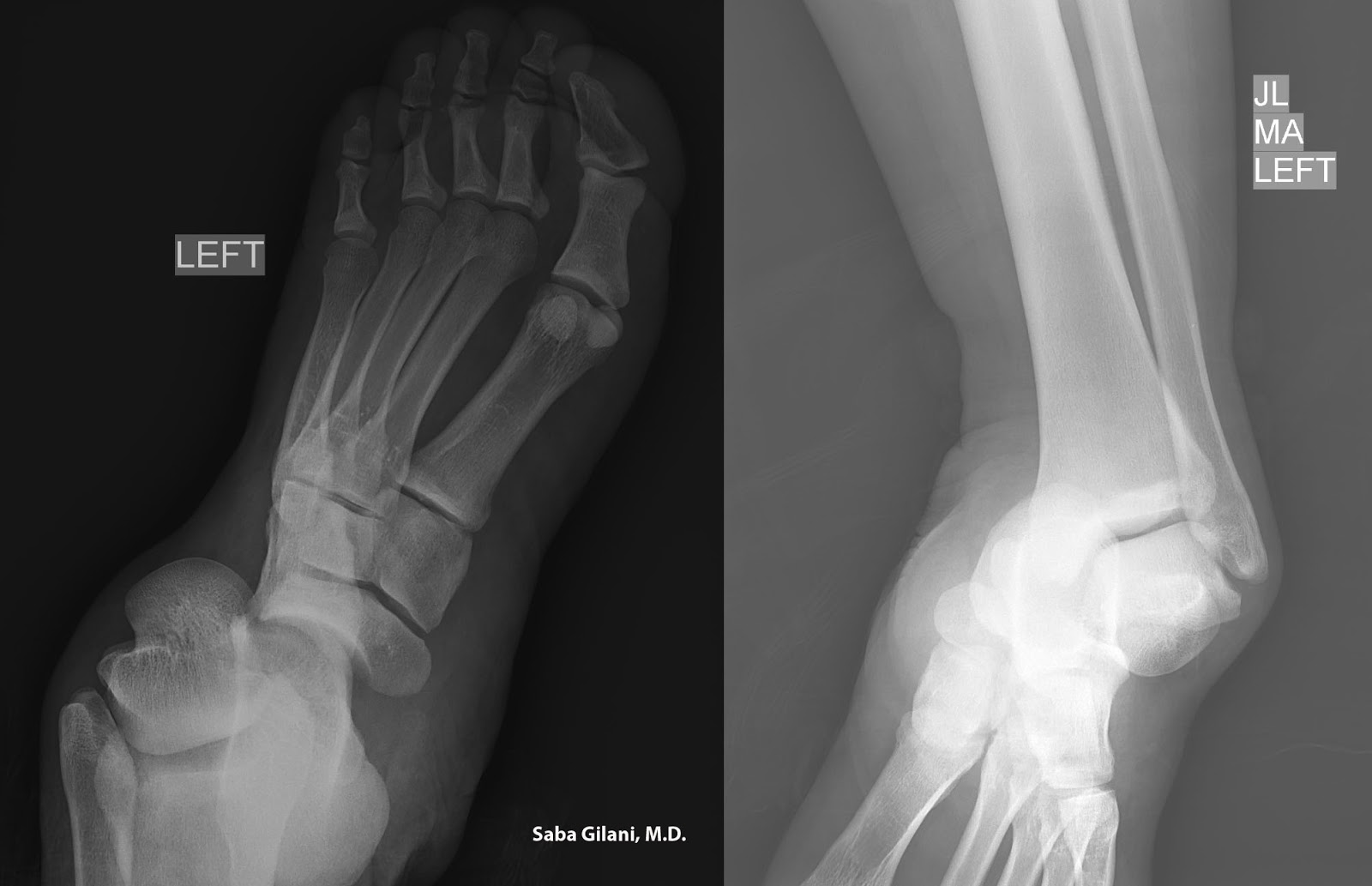 Roentgen Ray Reader: Subtalar Dislocation