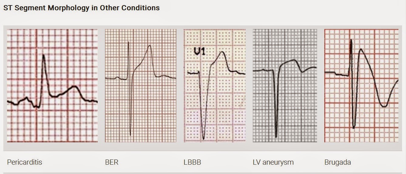Segmen ST | INA - ECG