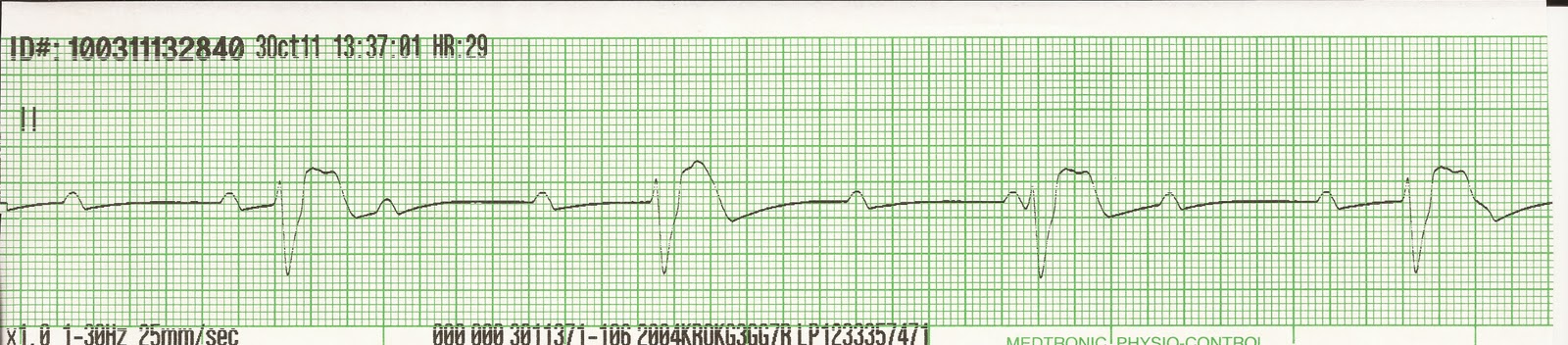 EKG Rhythm Strips 13- Heart Blocks