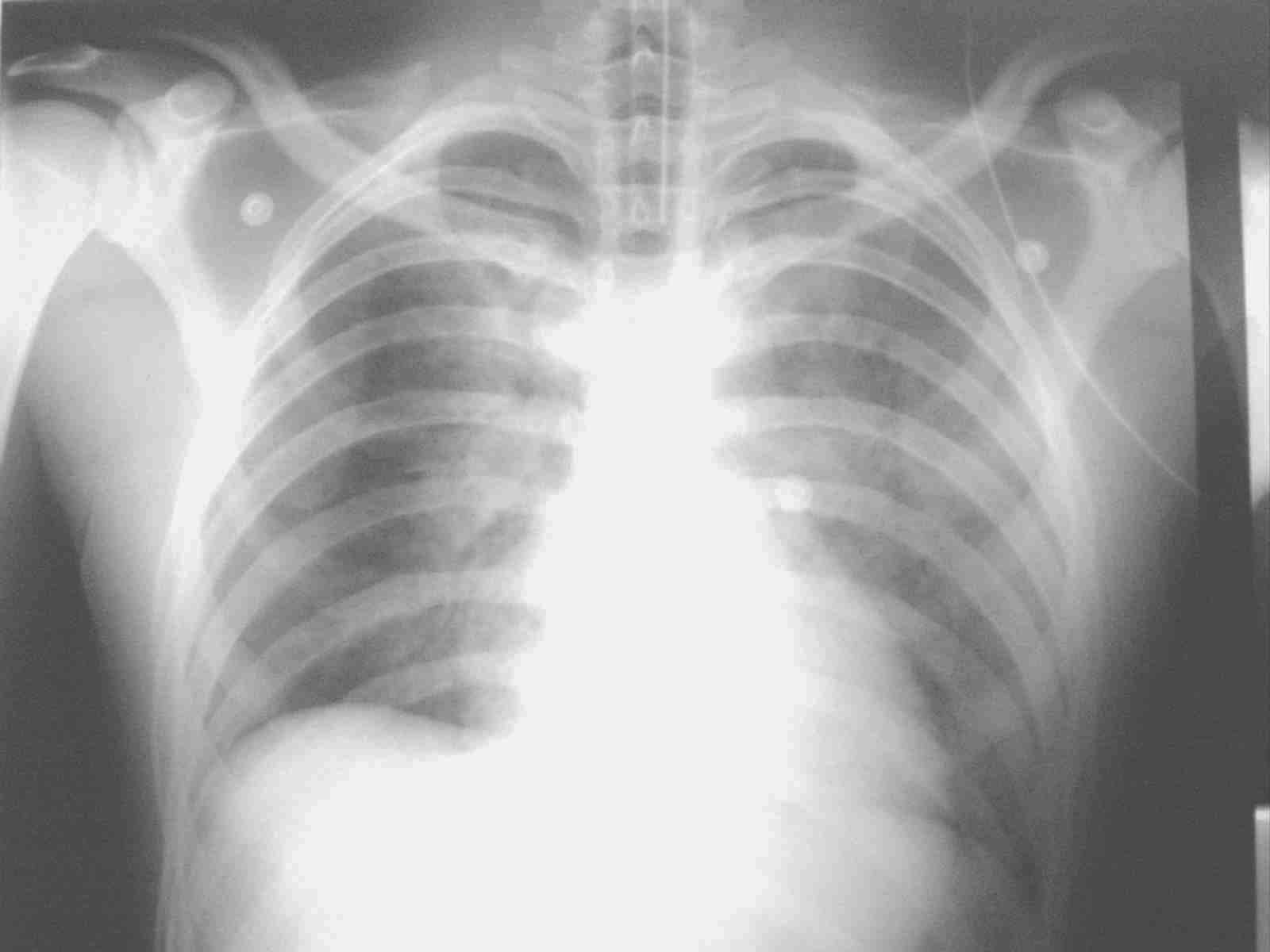 RADIOLOGIA: Técnica de lectura de una Radiografía de Tórax