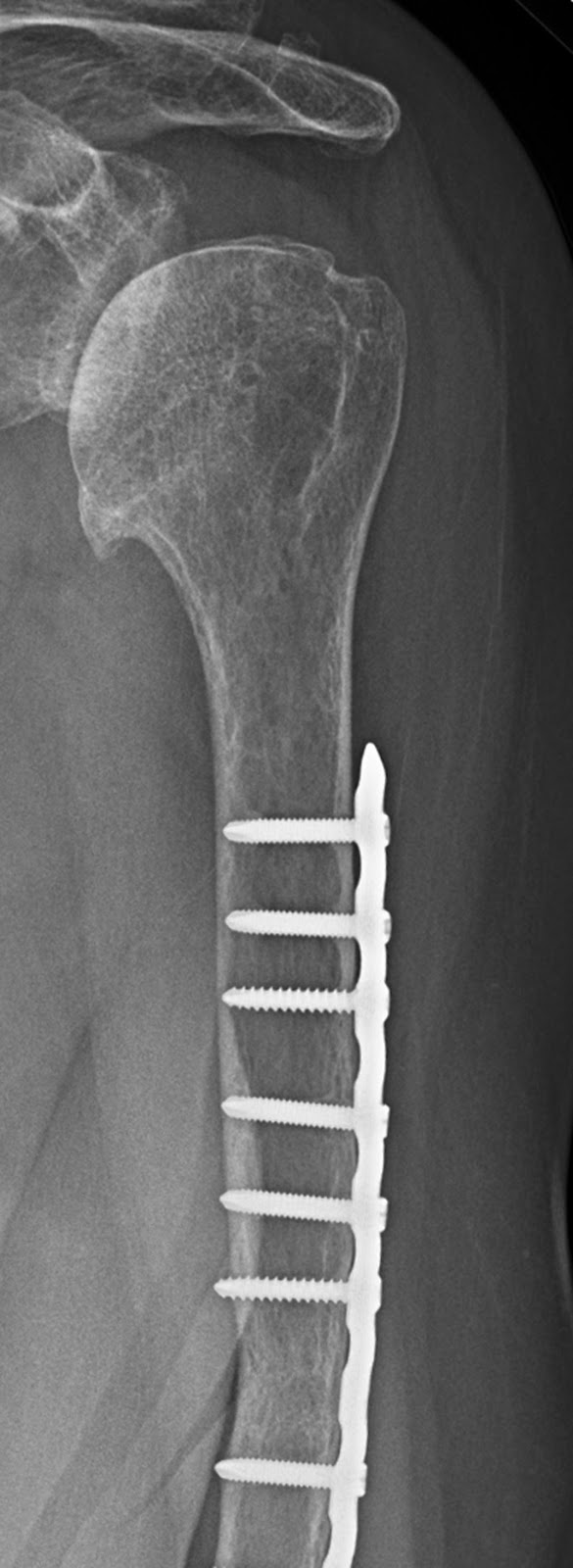 UW Shoulder and Elbow Academy: Shoulder joint replacement - humeral ...