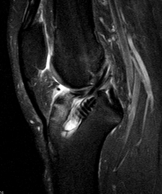 Anterior Cruciate ligament Reconstruction – what the Radiologist needs ...